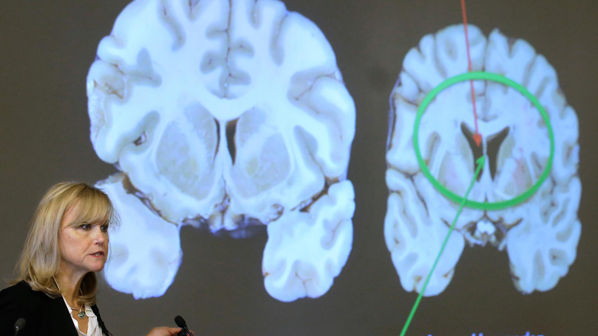 What is Chronic Traumatic Encephalopathy? NFL HQ shooter diagnosis ...