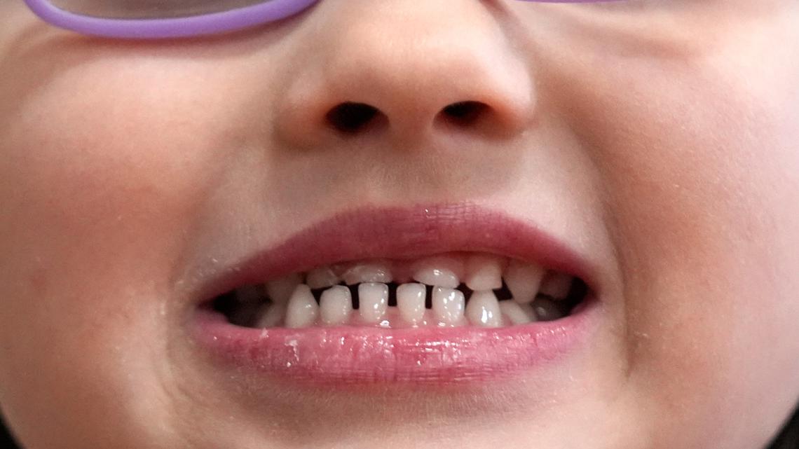 FDA, RFK Jr. aim to remove fluoride supplements used to protect kids ...