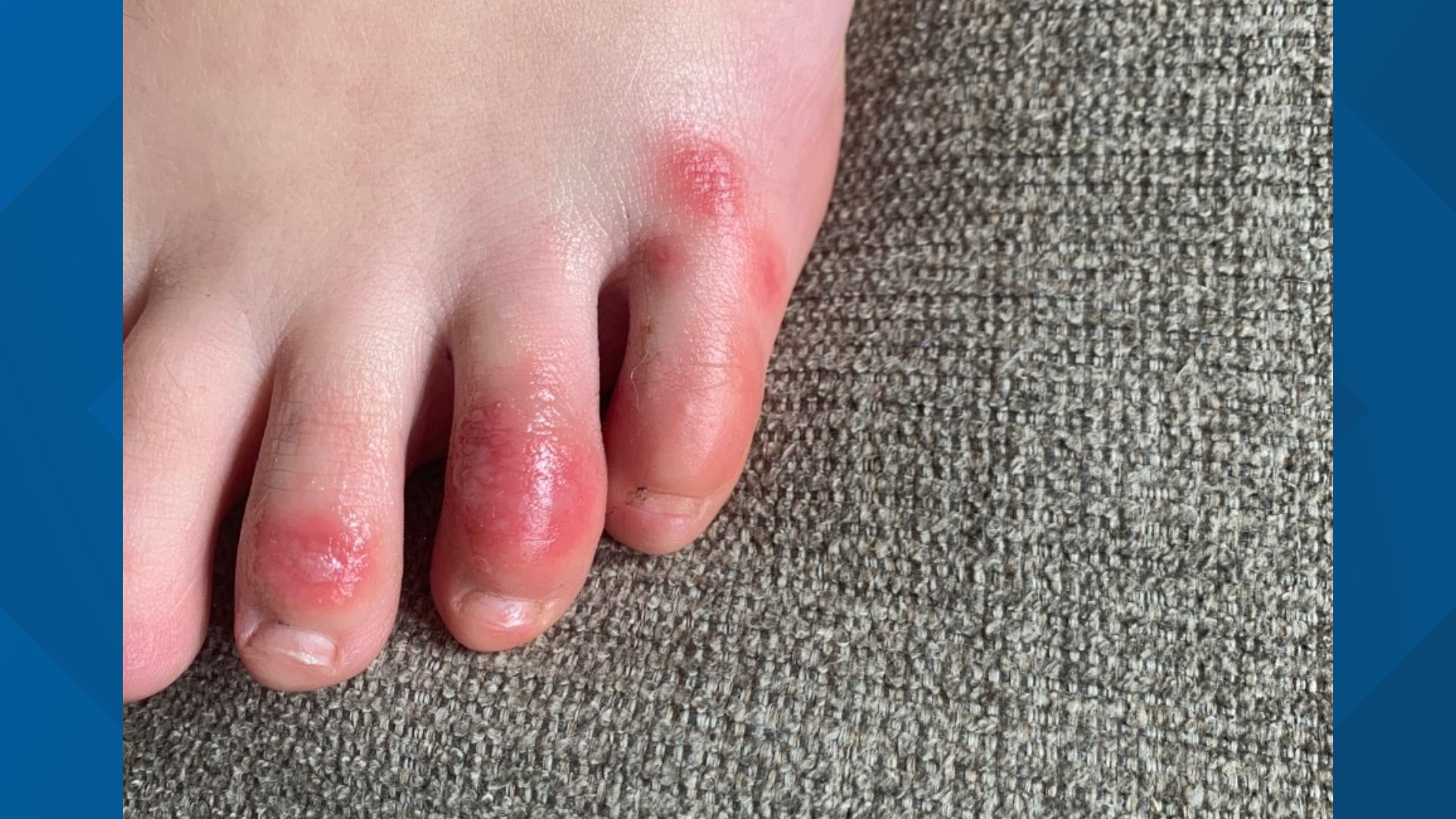 What are COVID toes? Skin condition may be linked to coronavirus ...