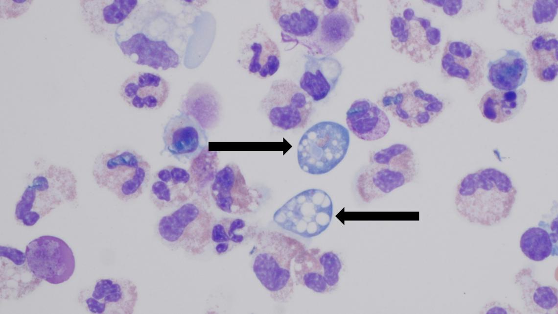 Brain-eating amoeba infection: What to know after Missouri case ...