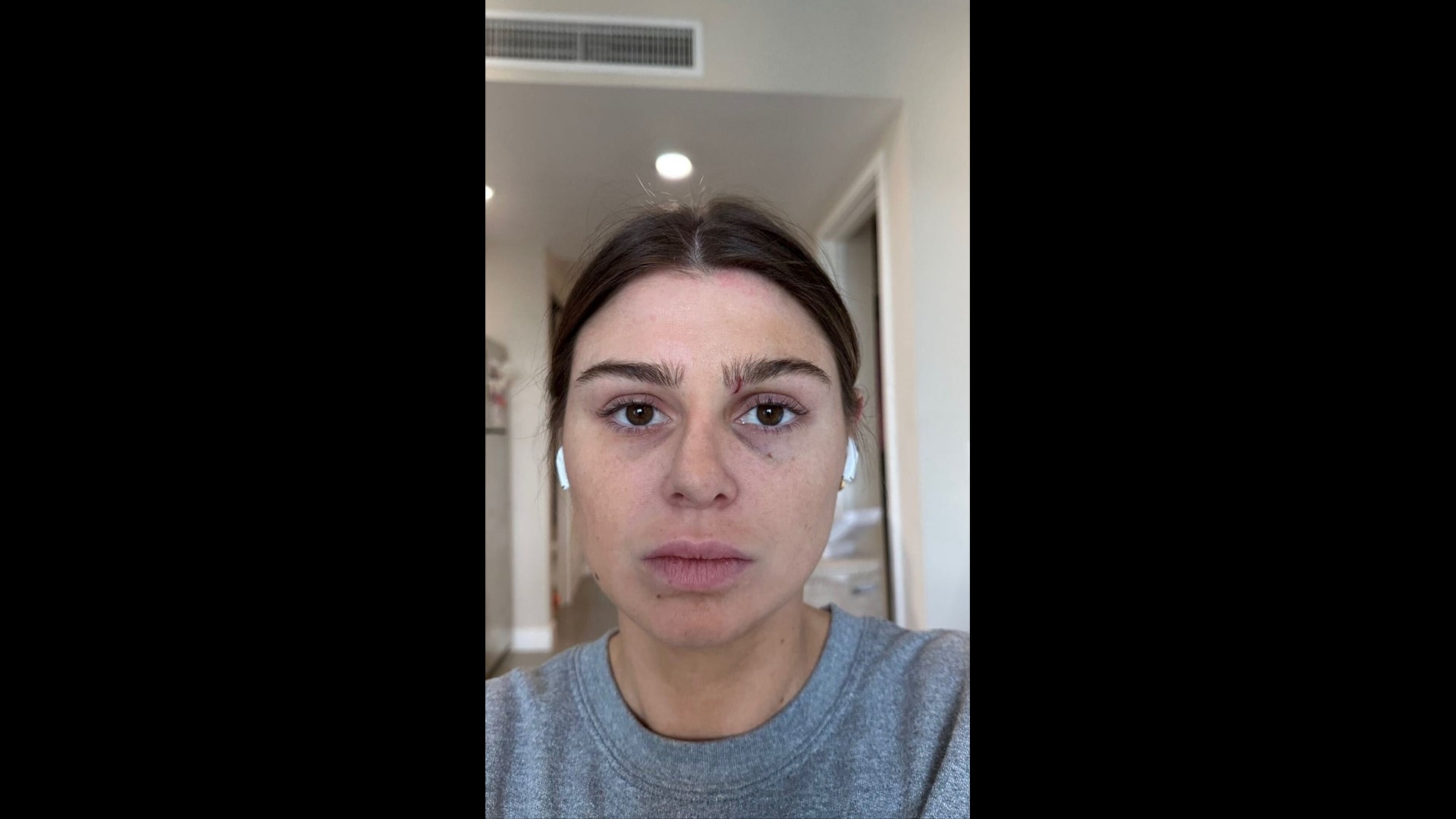 Raquel Leviss Alleges Scheana Shay Gave Her a Black Eye: PICS | 9news.com