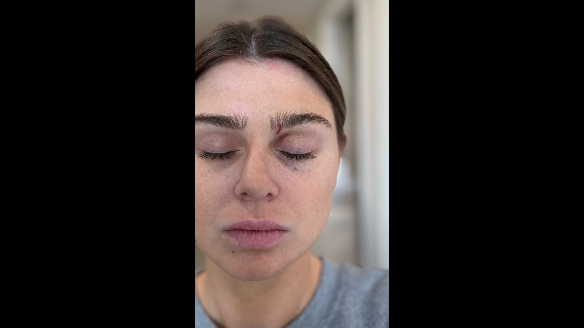 Raquel Leviss Alleges Scheana Shay Gave Her a Black Eye: PICS | 9news.com