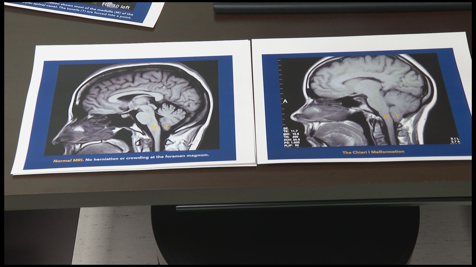 Woman diagnosed with Chiari malformation after years of pain | 9news.com