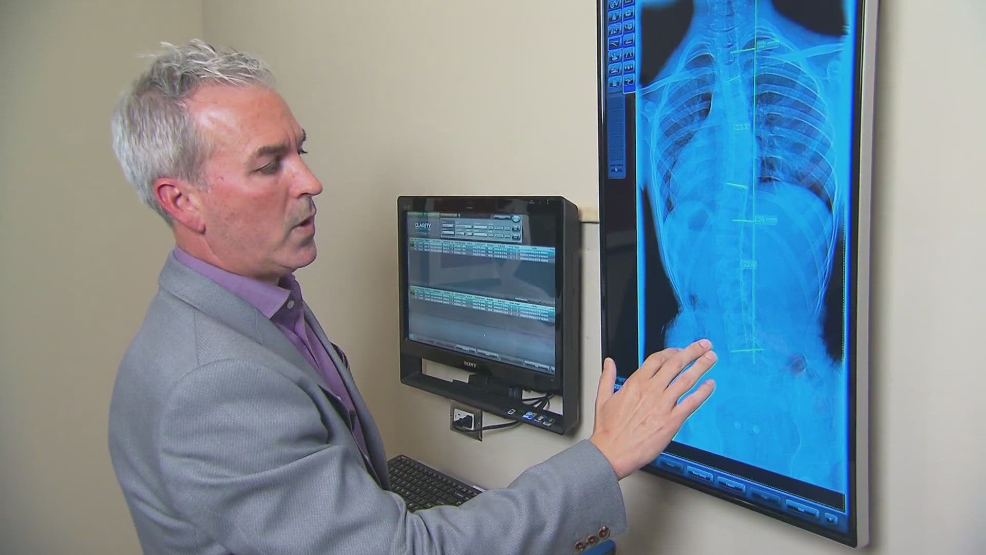 Checking kids for scoliosis early is important, says pediatric spine ...