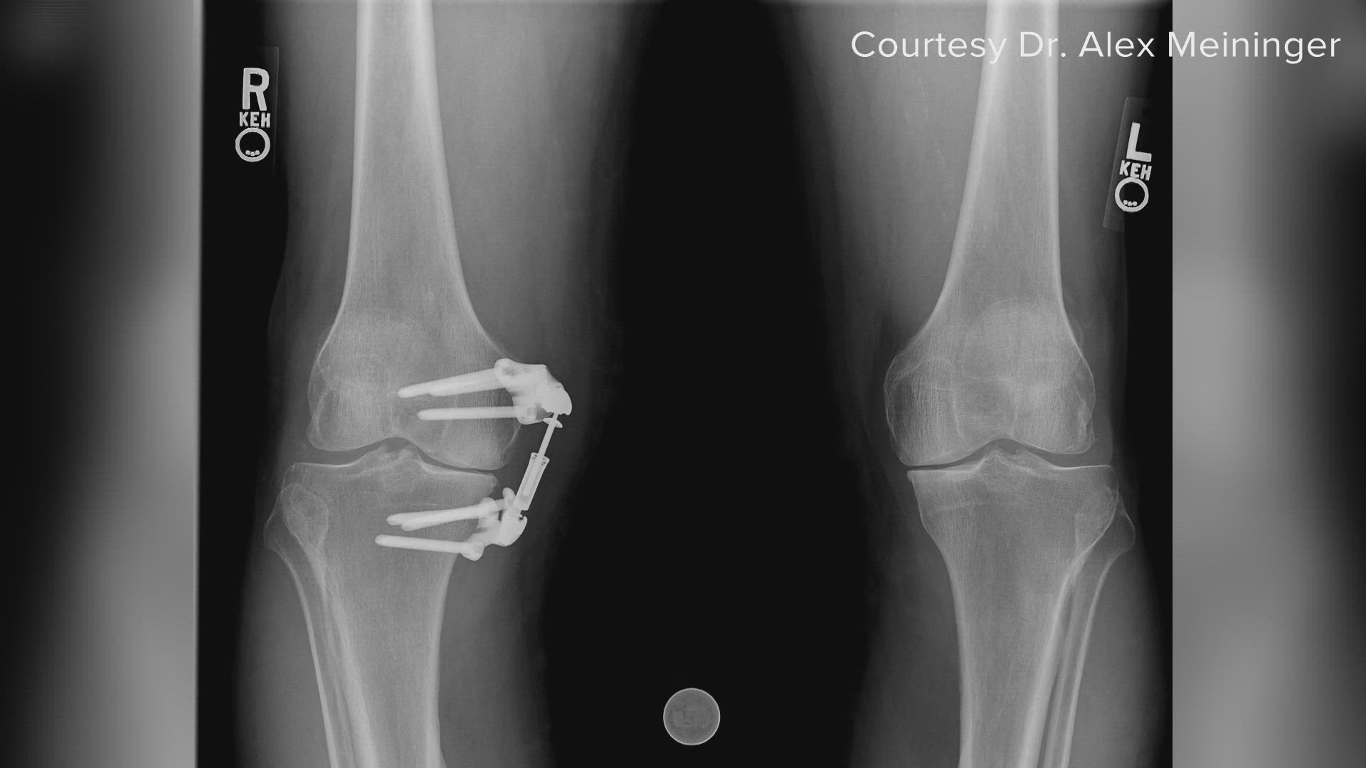 Doctor explains medical device that offers alternative to knee ...