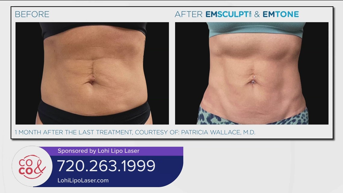 Lohi Lipo Laser - July 31, 2023 | 9news.com