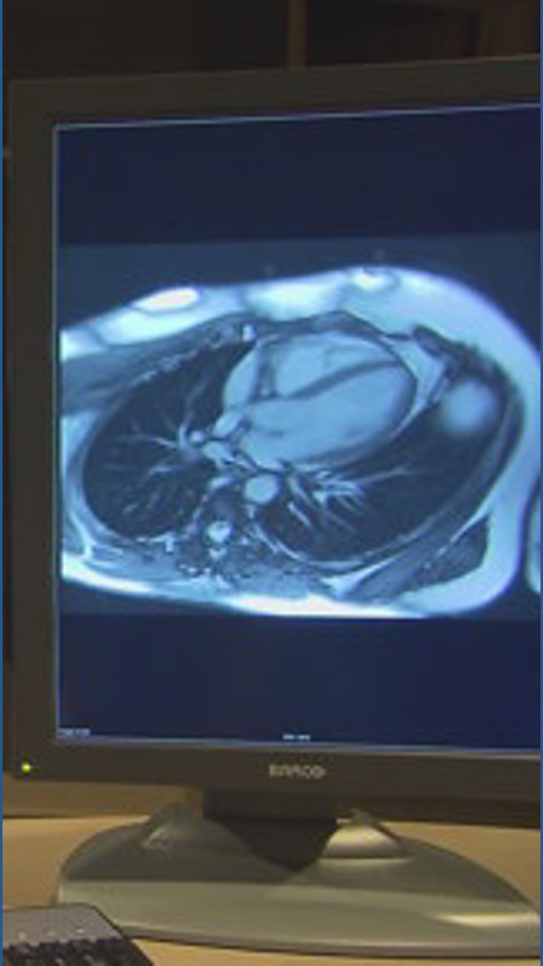What to know about becoming a kidney donor | 9news.com