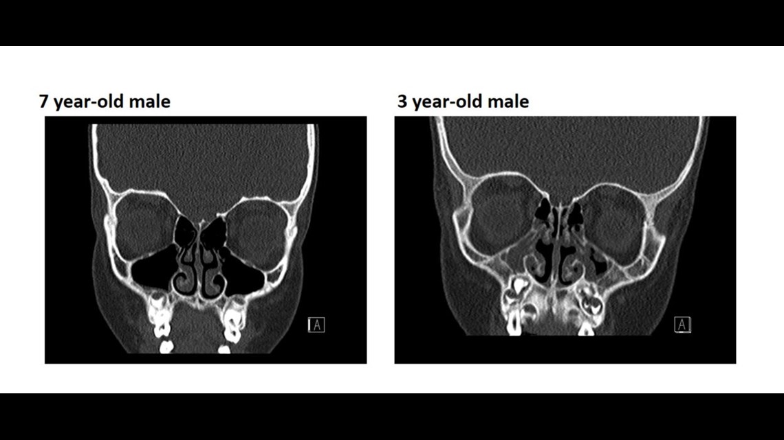 Telling the difference between the common cold and sinusitis | 9news.com