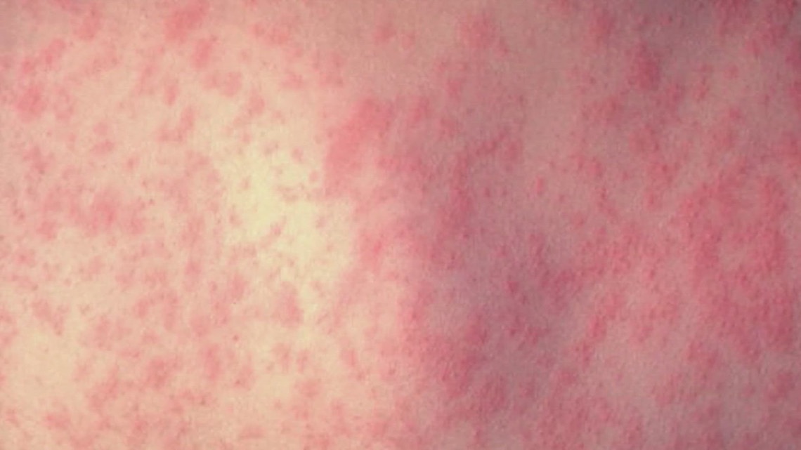 2nd Colorado measles case confirmed in infant | 9news.com