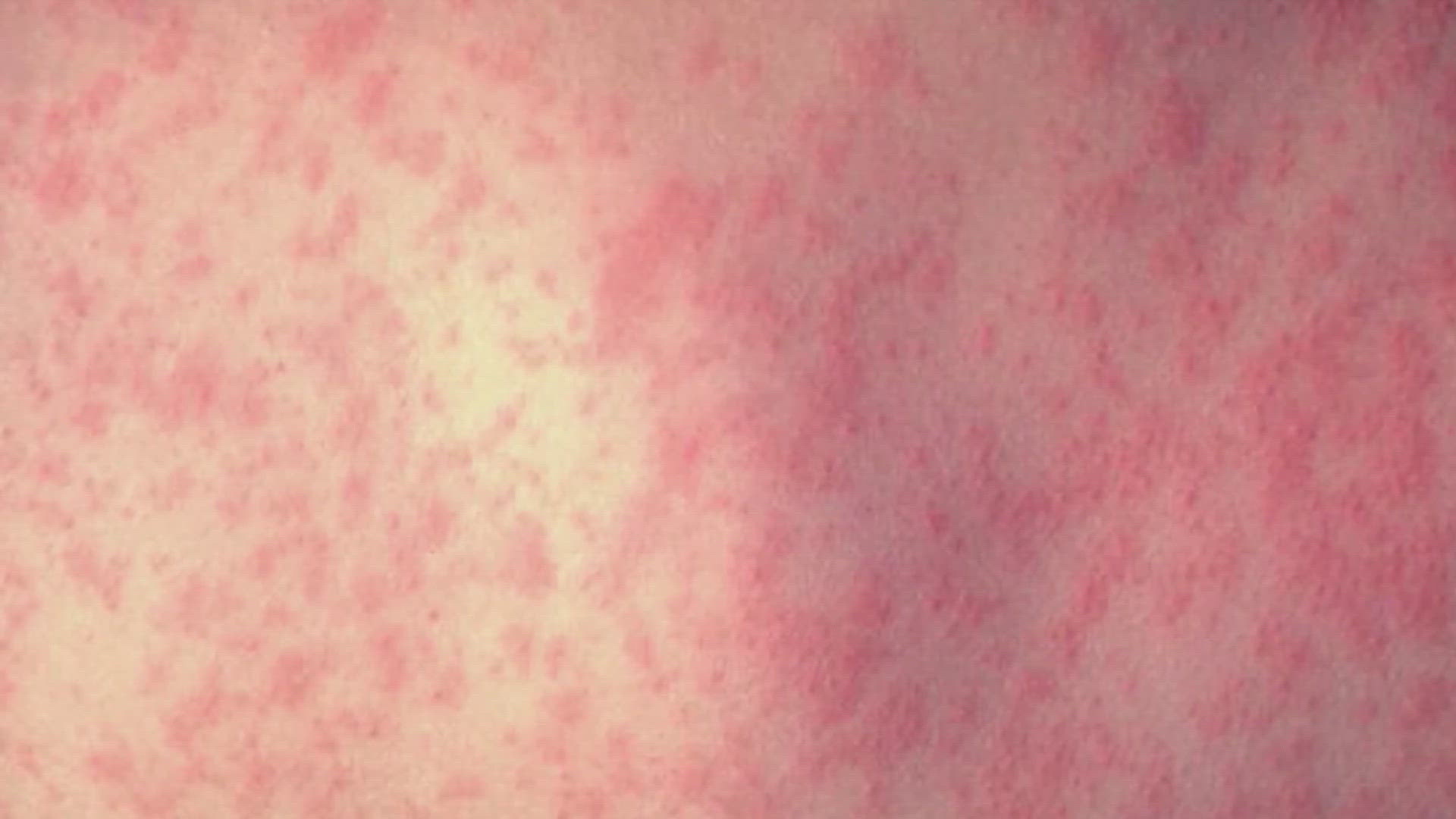 Second measles case confirmed in Denver | 9news.com