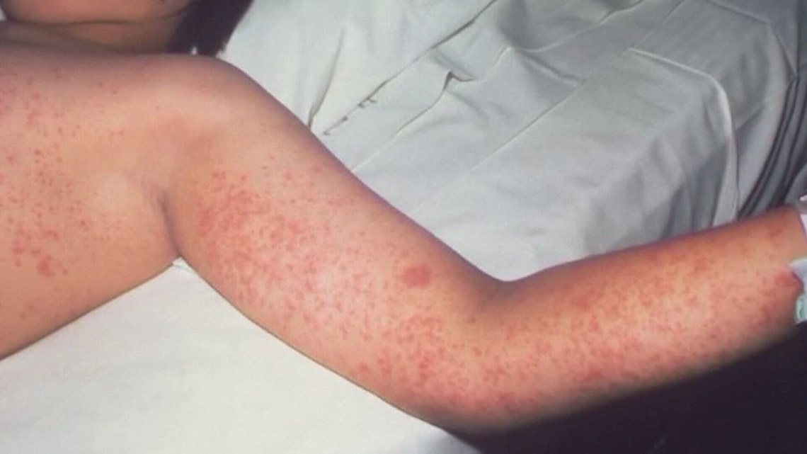 Measles outbreak growing in Utah, Arizona | 9news.com