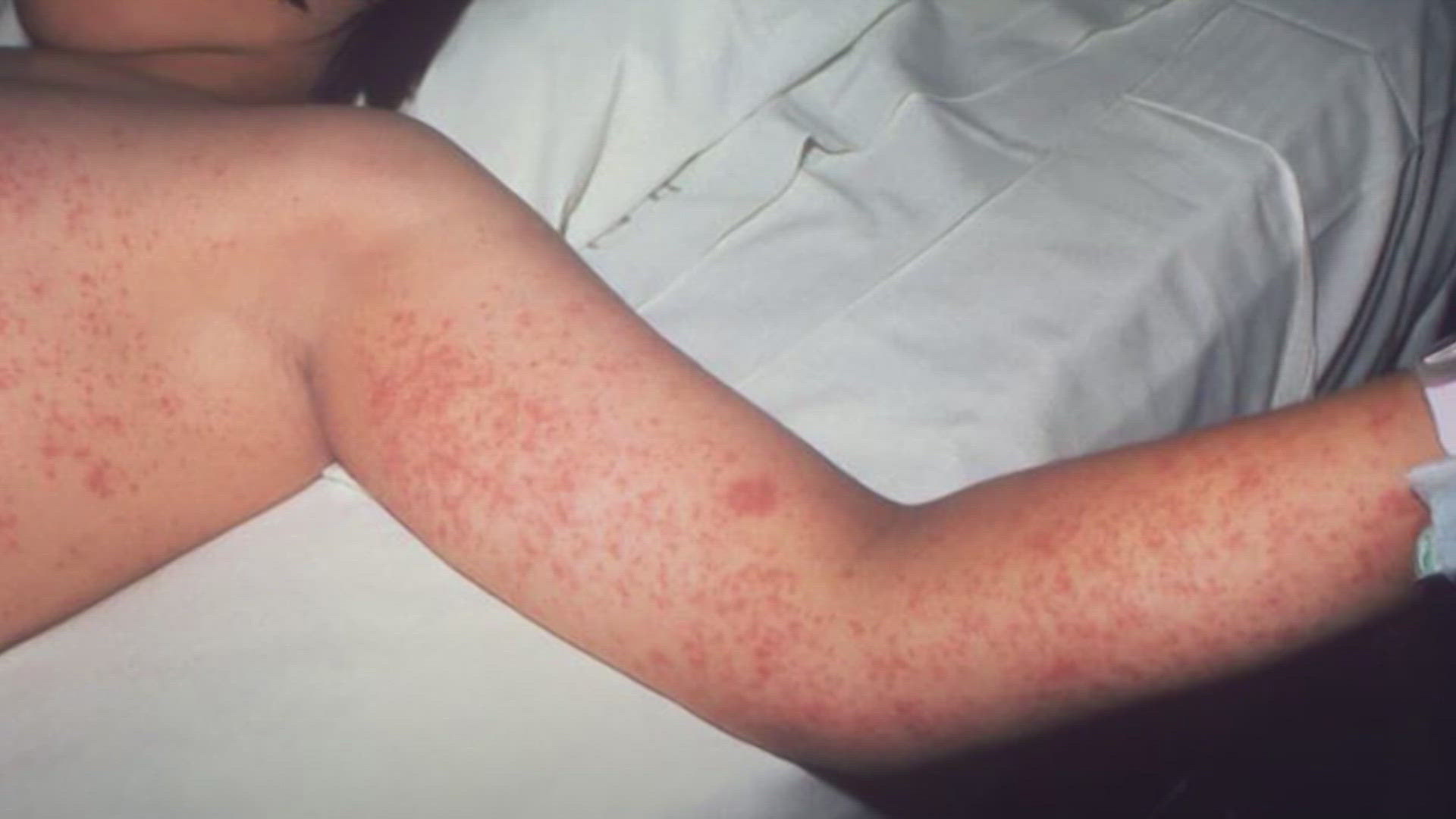 Measles: what to know about one of the world's most contagious viruses ...