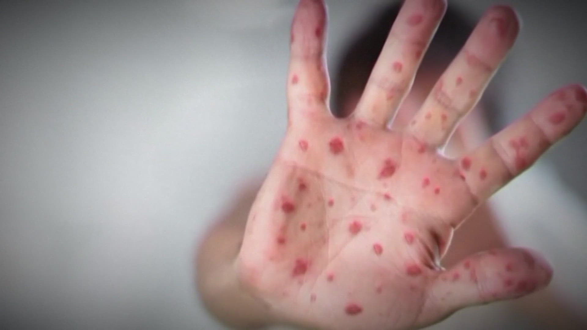 Can you get measles if you've been vaccinated? | 9news.com
