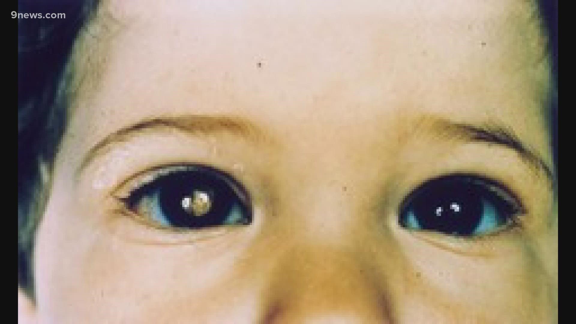 How to be proactive about your child's eye health | 9news.com