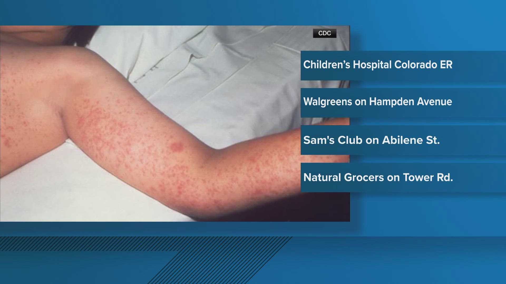 Child confirmed to have measles, exposure warning at Aurora locations ...