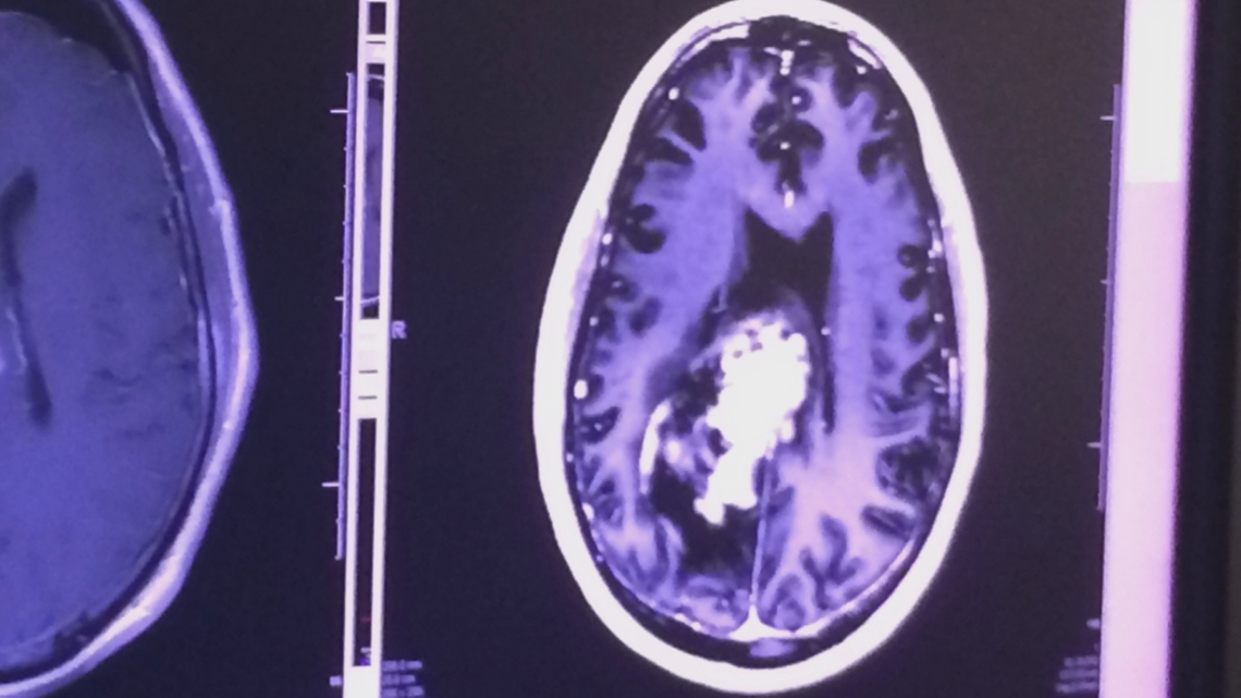 Denver man shares decade-long battle with chemo brain fog | 9news.com