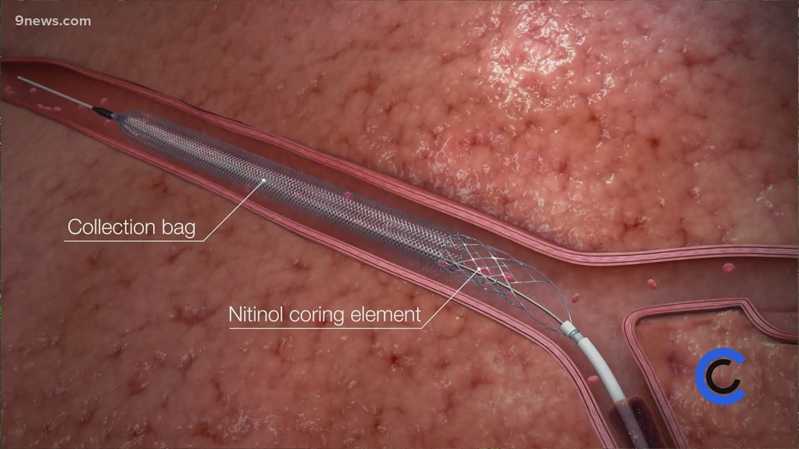 Inari Medical - VIR - ClotTriever - December 17, 2020 | 9news.com