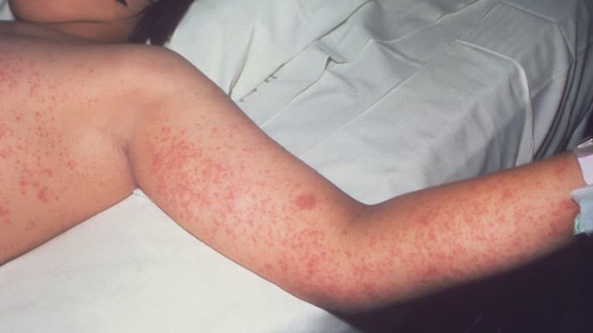 Signs of measles, plus can you get it twice? | Your questions answered | 9news.com