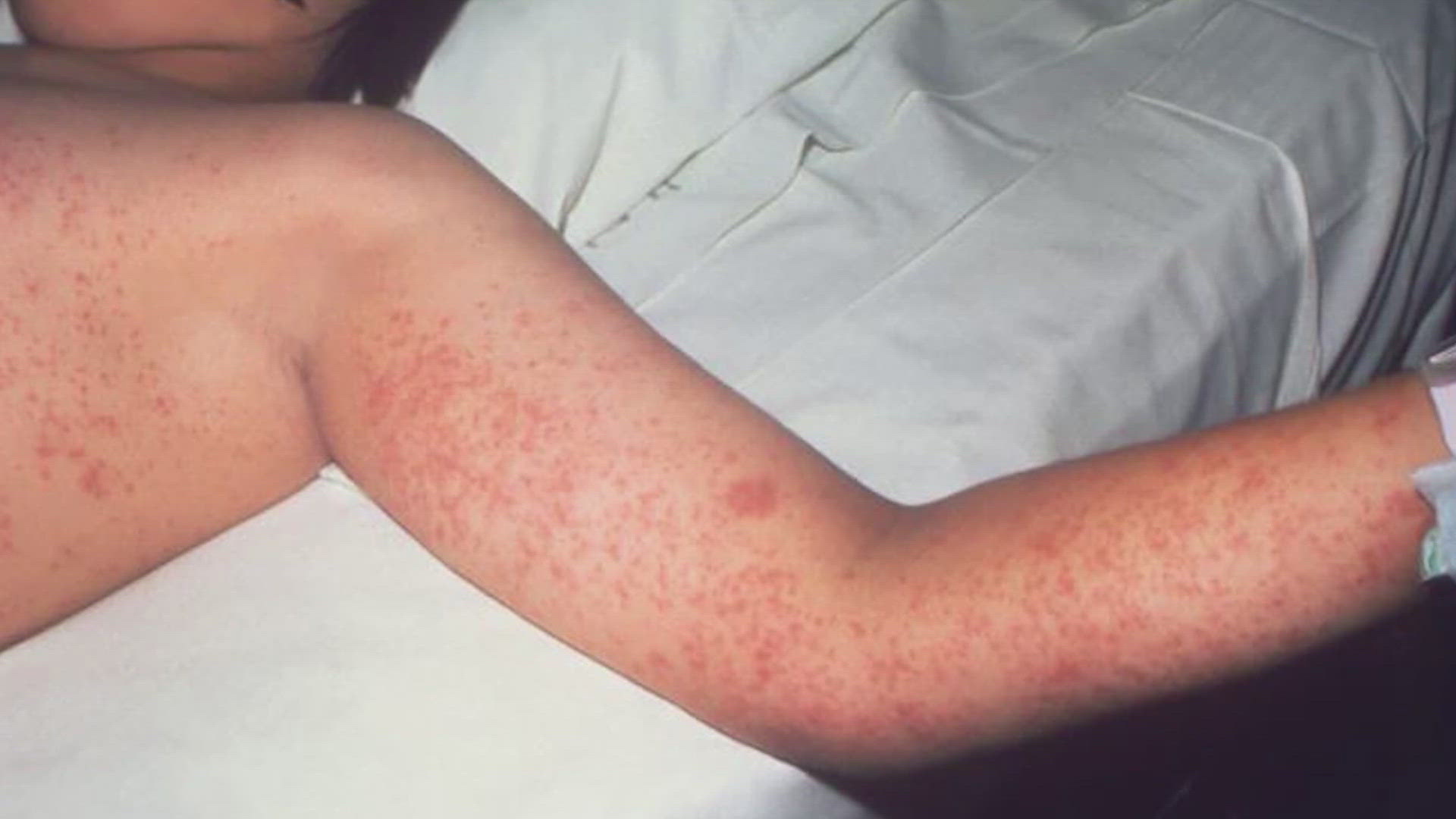 CDC suggests Vitamin A could help treat measles | 9news.com