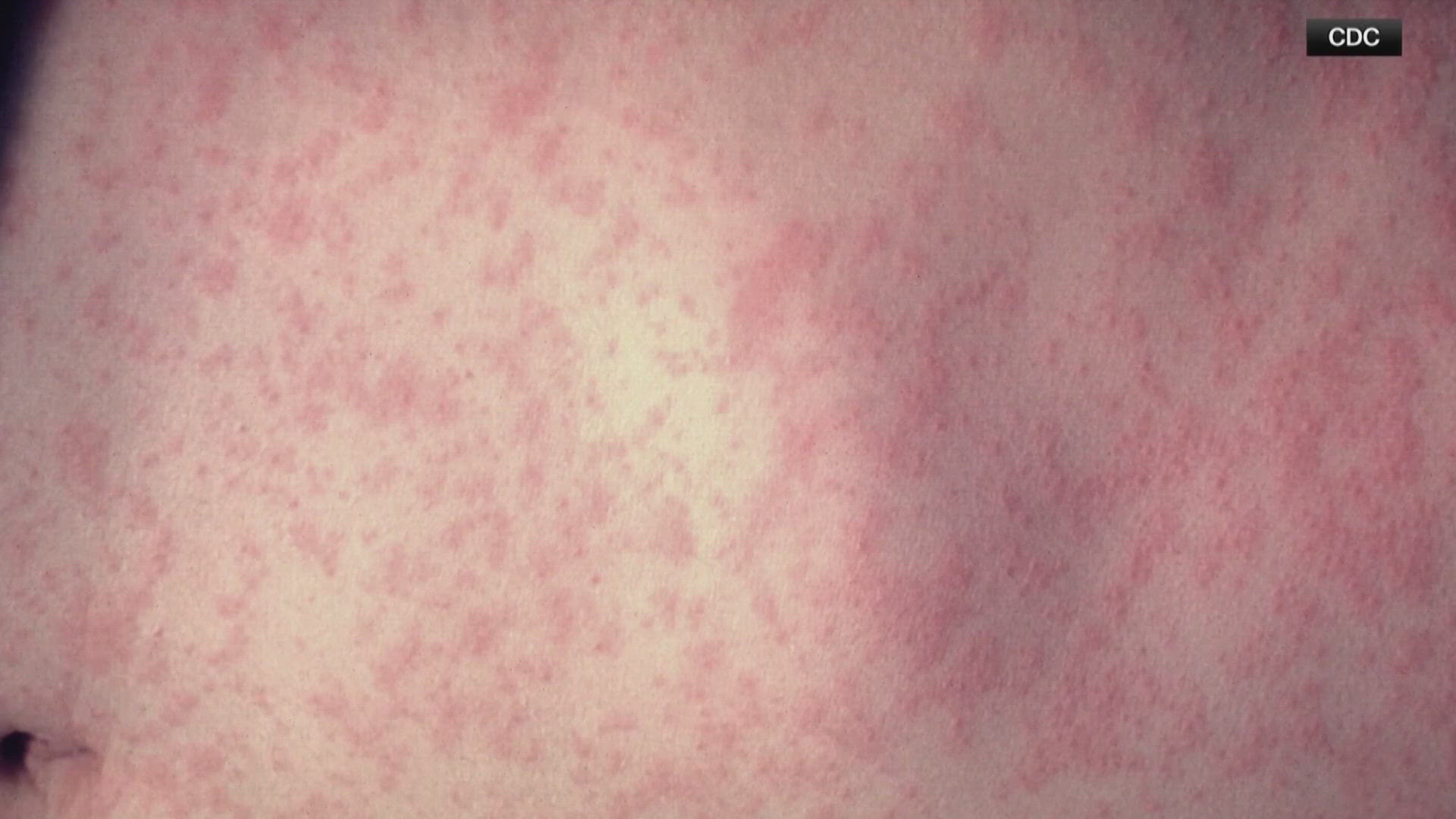 Third measles case linked to flight arriving in Denver | 9news.com