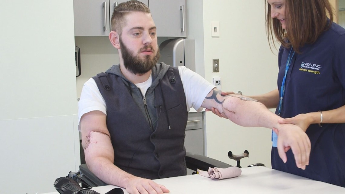 Local man becomes one of the first double arm transplant recipients ...